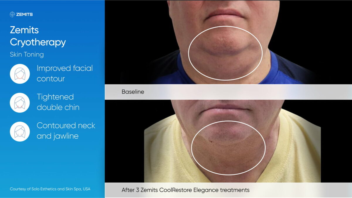 Cryo Slimming Or Kybella For Double Chin | Happy Valley Healthy Beauty